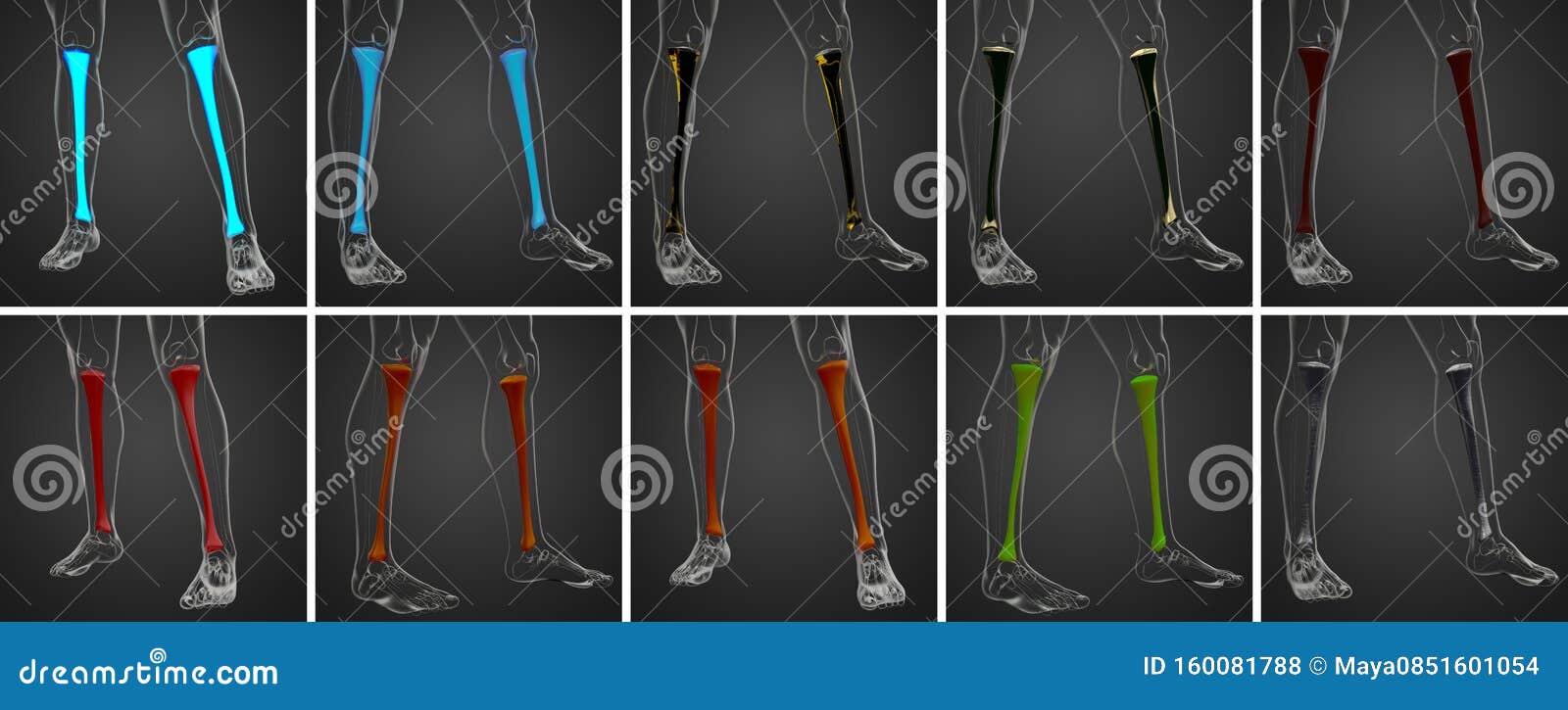 Tibia Bone Osteomyelitis Cartoon Vector | CartoonDealer.com #291673279