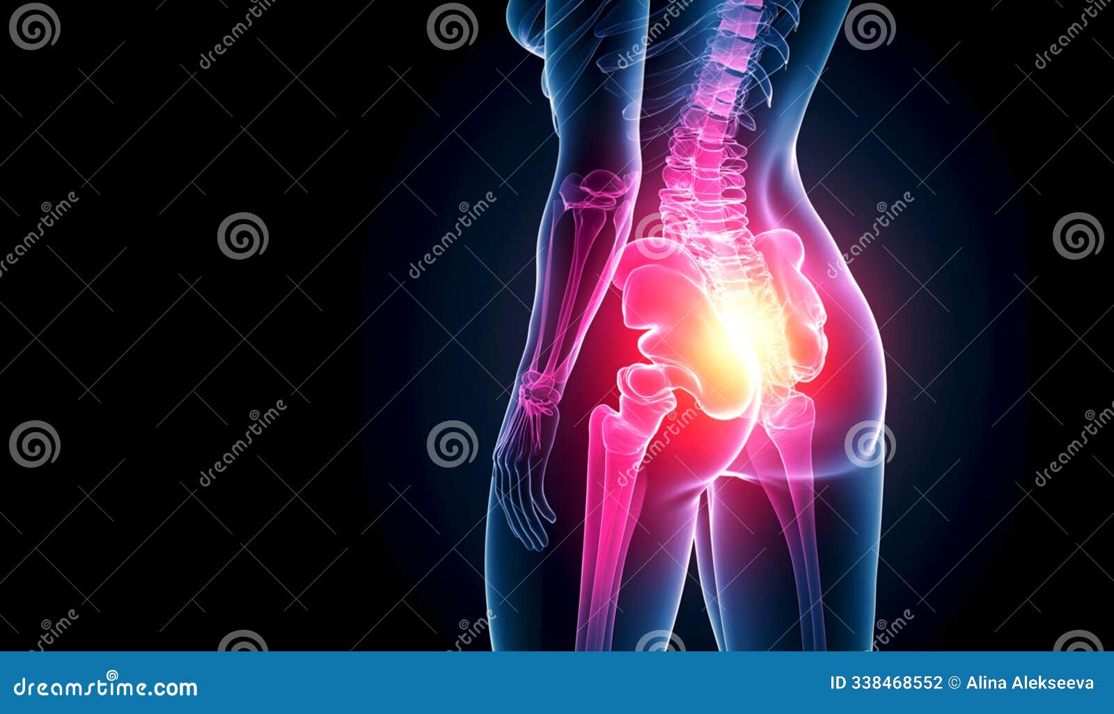3D Rendering of Sciatic Nerve Pain, Lower Back and Hip. Sciatic Pain ...