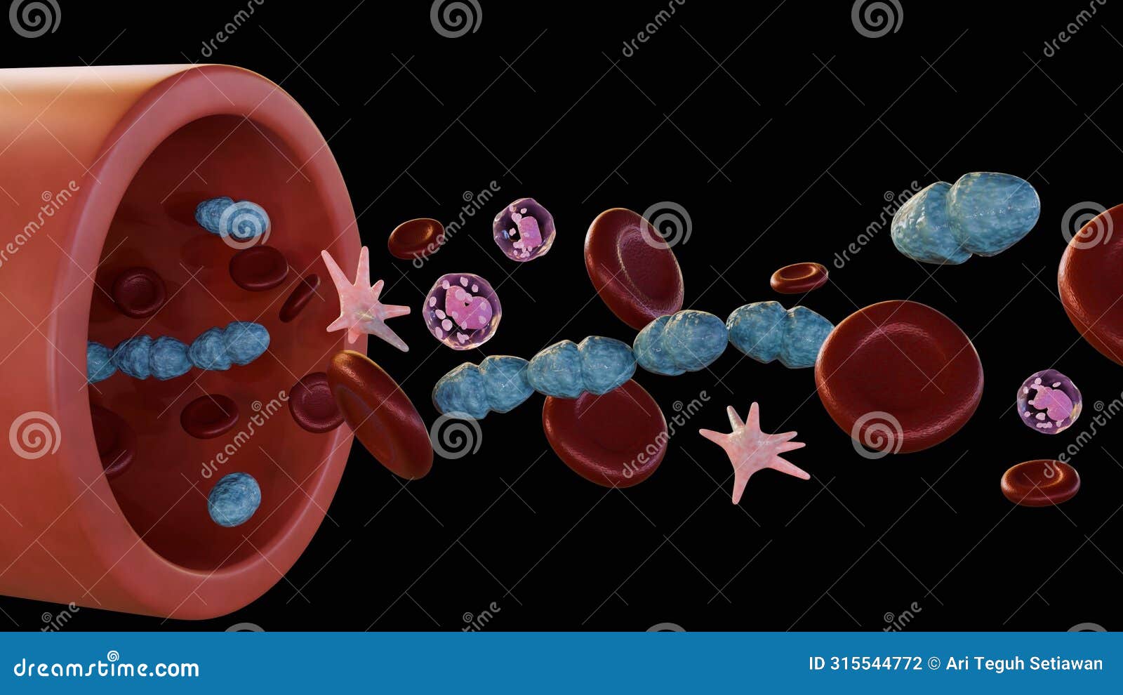 3d Rendering of Septicemia, or Sepsis by Streptococcus Pyogenes Stock ...