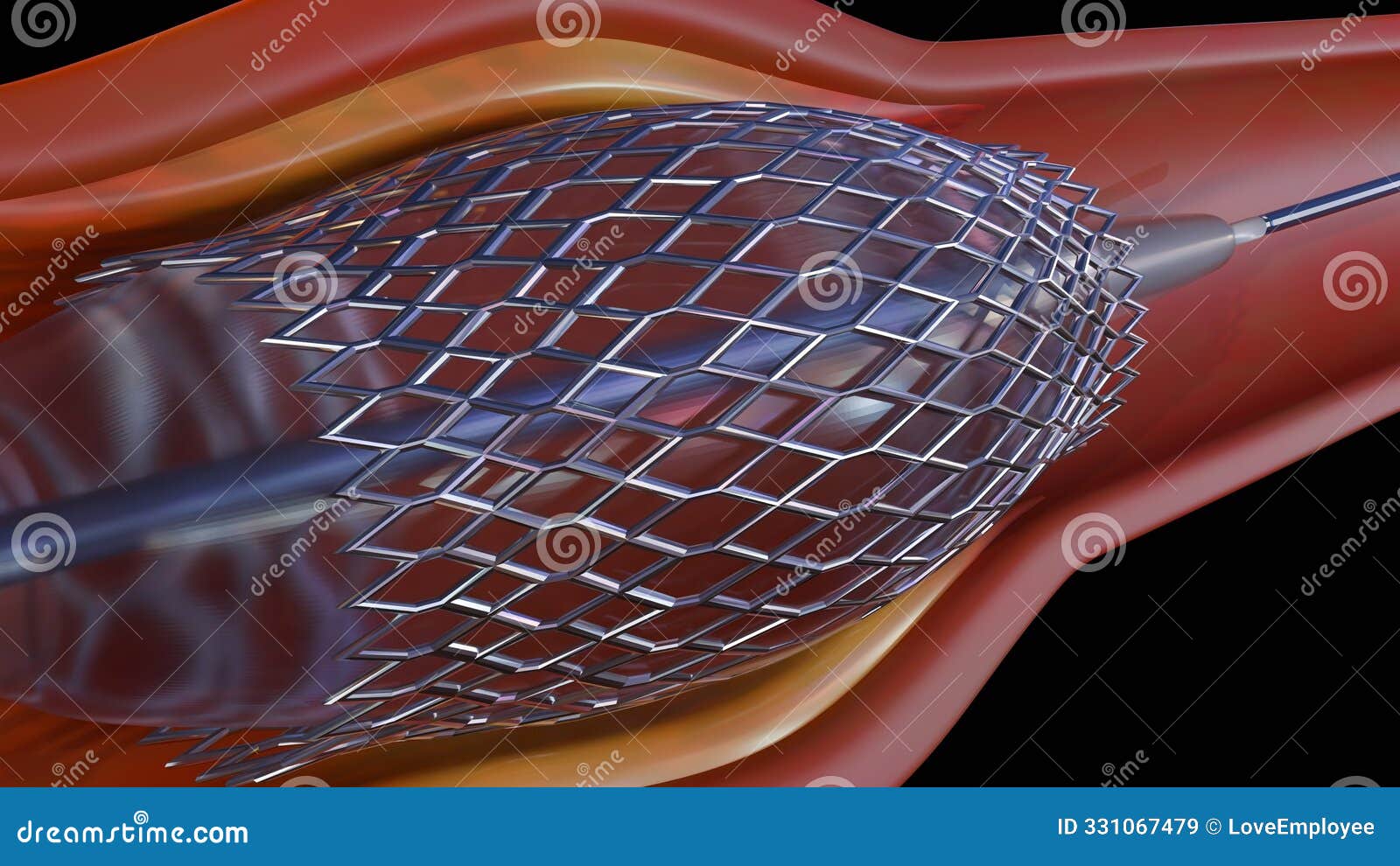A 3D Rendering Of A Stent Inside A Blood Capillary Royalty-Free Stock ...