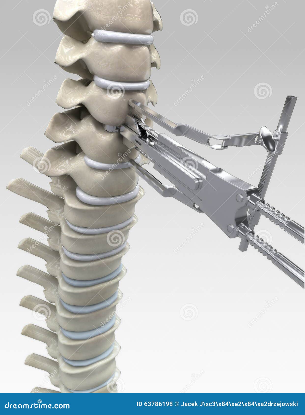 3D Spine Illustration of an Human Spine Surgery Stock Photo - Image of ...