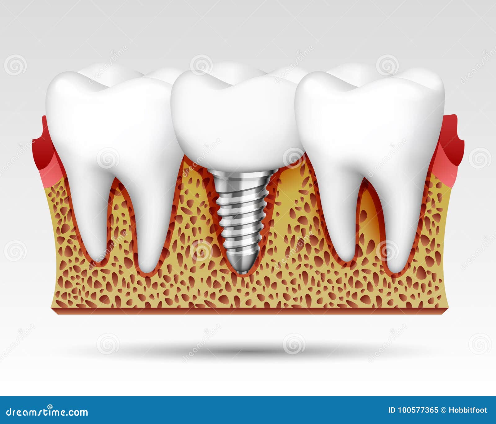 3d Teeth in a Cut with Nerve Endings. Stock Vector - Illustration of ...