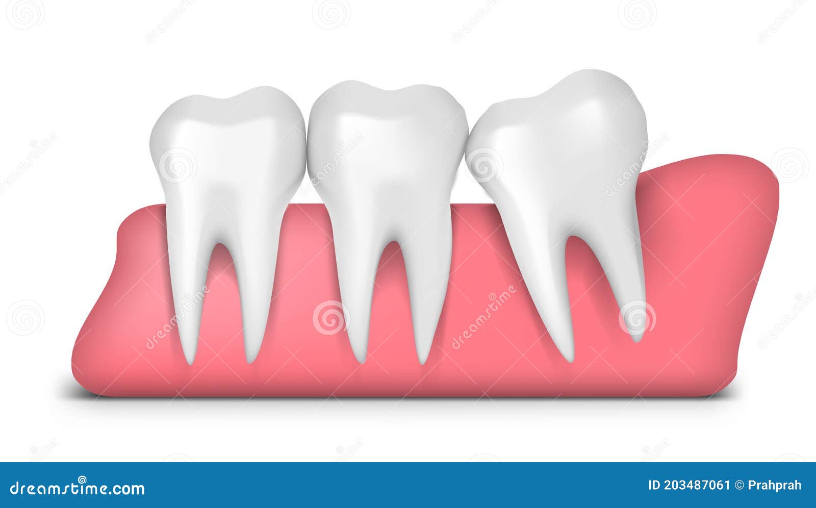 3D Teeth With Wisdom Mesial Impaction Problem Cartoon Vector ...