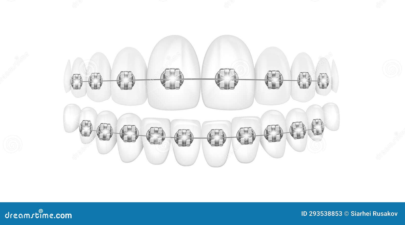 3d Vector Illustration, Realistic Teeth with Braces. Alignment of the ...