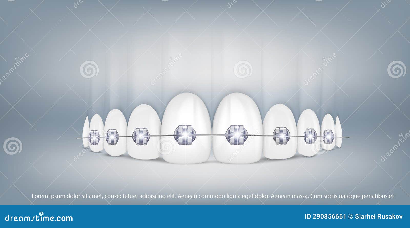 3d Vector Illustration, Realistic Teeth with Braces Upper and Lower Jaw ...