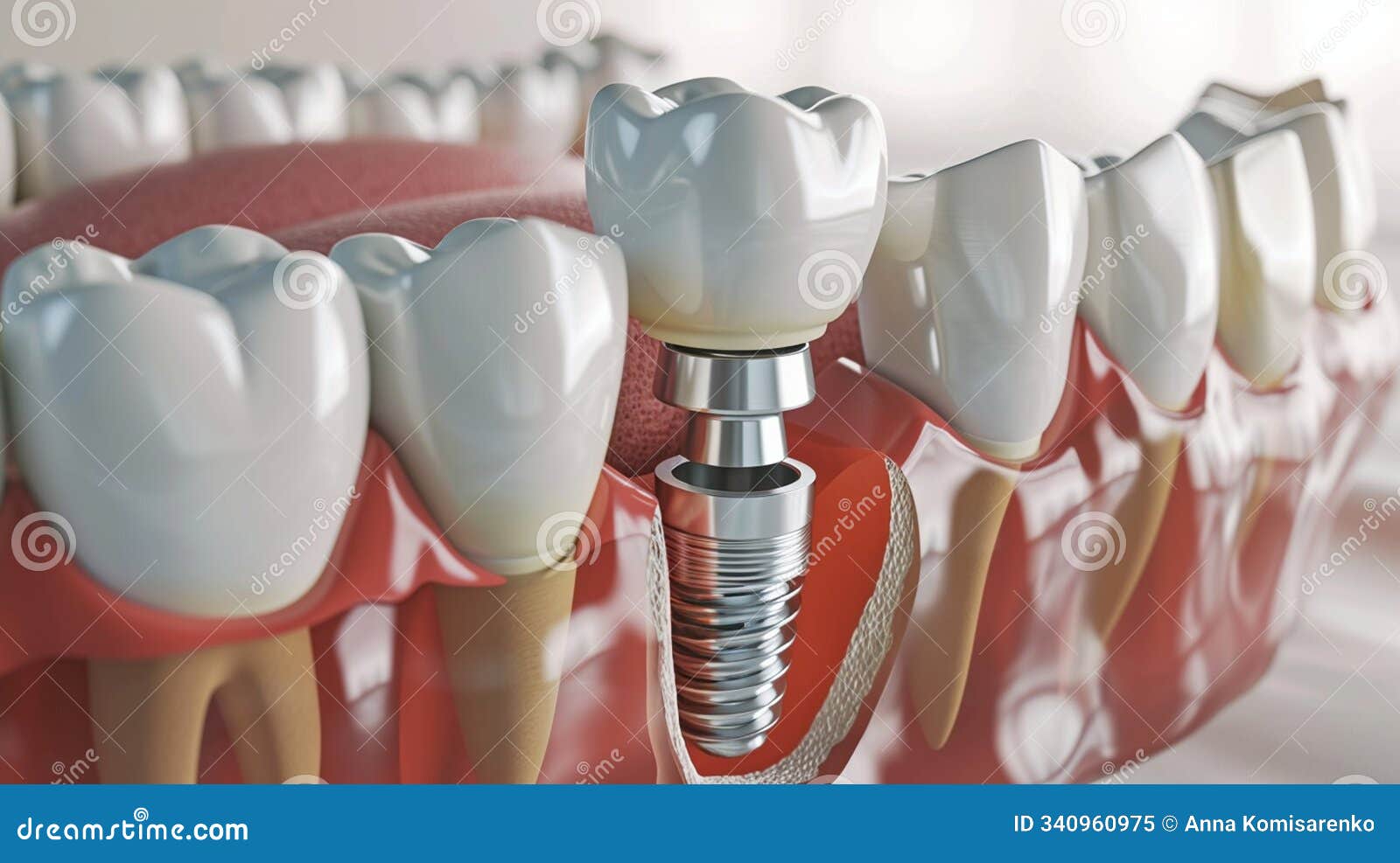 3D Visualization of the Jaw with Cast Pin and Tooth Restoration. Stock ...