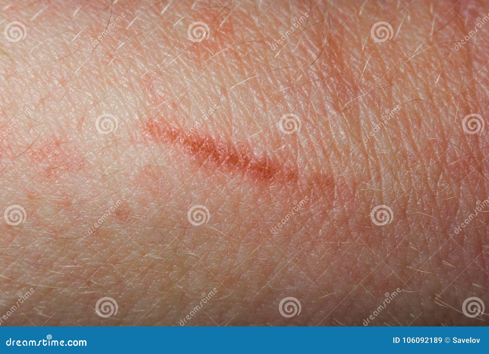 Damage and Scratch on the Skin of the Macro Stock Image - Image of ...