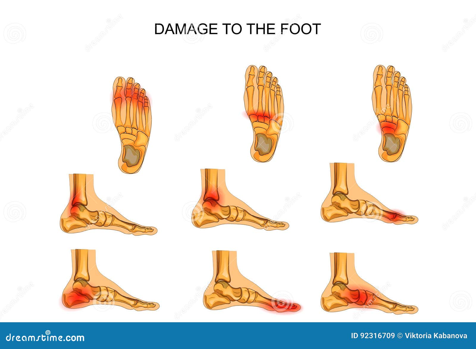 Damage to the foot stock vector. Illustration of ligament - 92316709