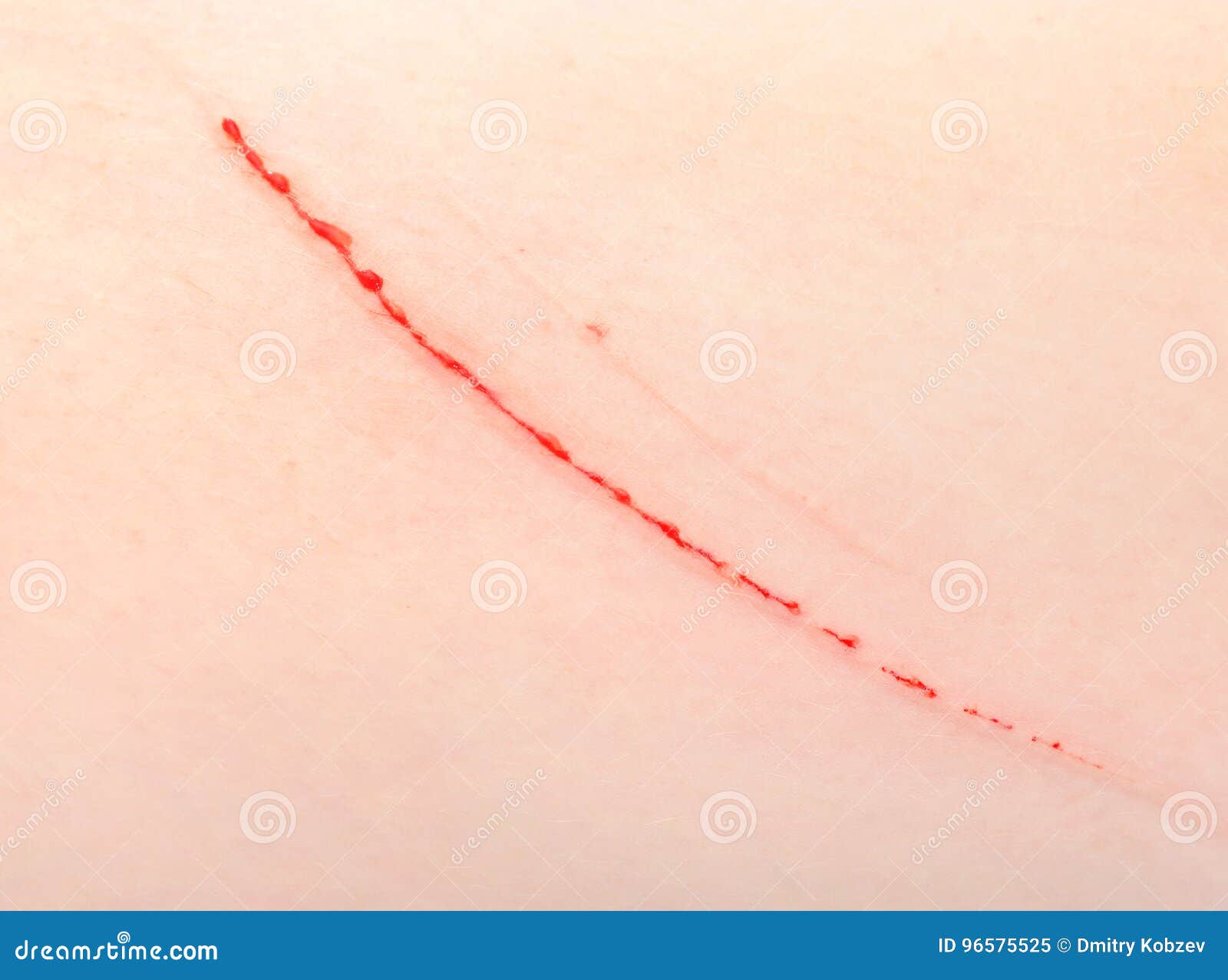 Damage To the Top Layer of the Skin Stock Image - Image of human ...