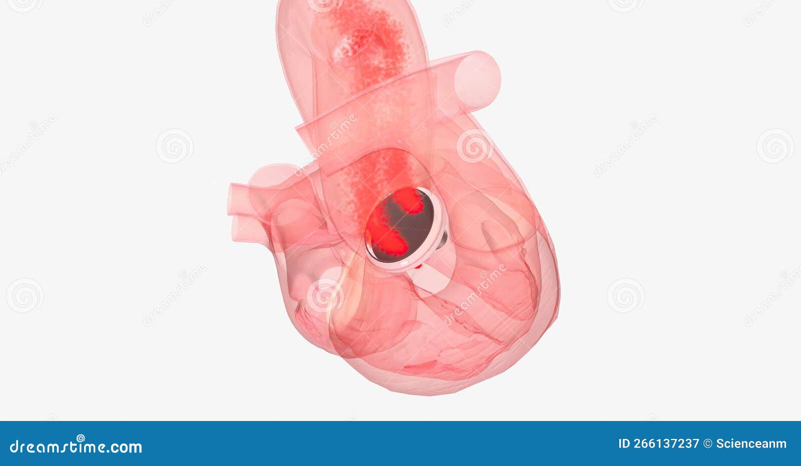 The Damaged Aortic Valve May Also Be Replaced with a Mechanical or a ...
