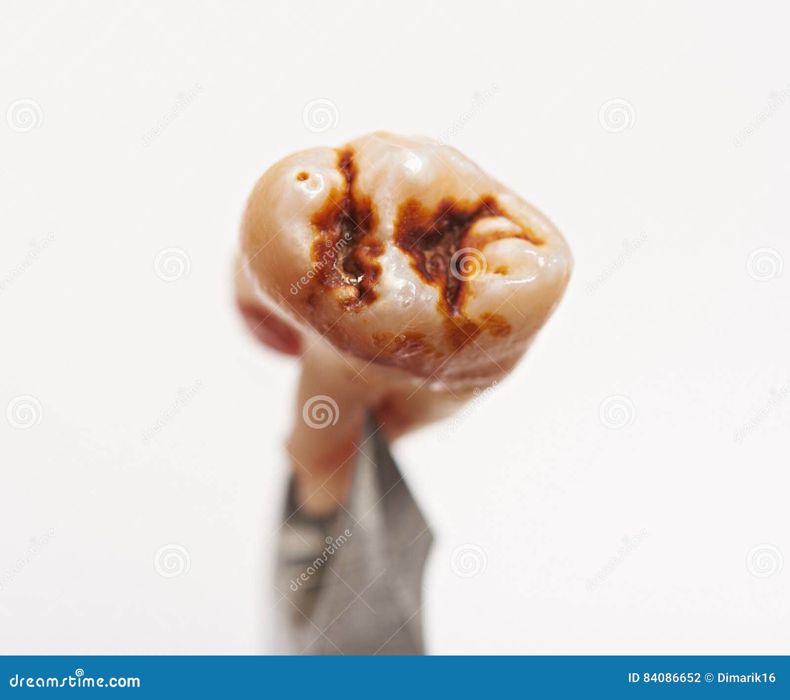 Damaged by cavity teeth stock photo. Image of damaged - 84086652