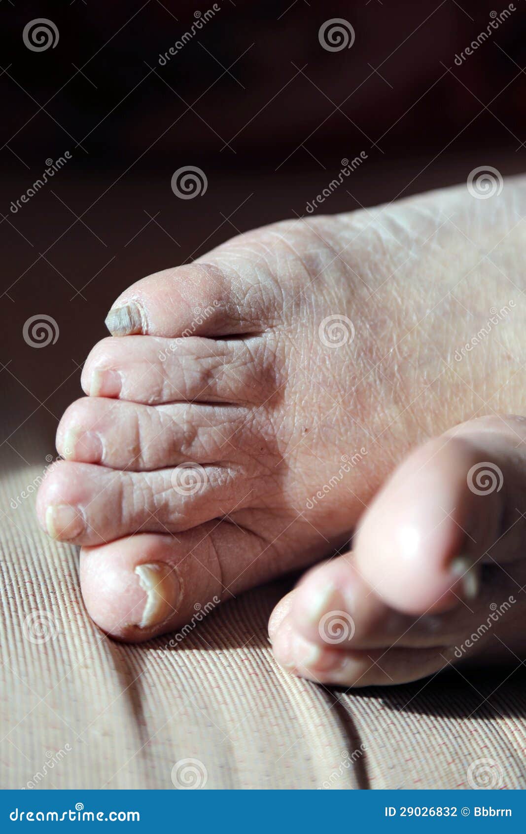 Damaged Nails of Womans Feet Stock Photo - Image of arthritis, closeup ...