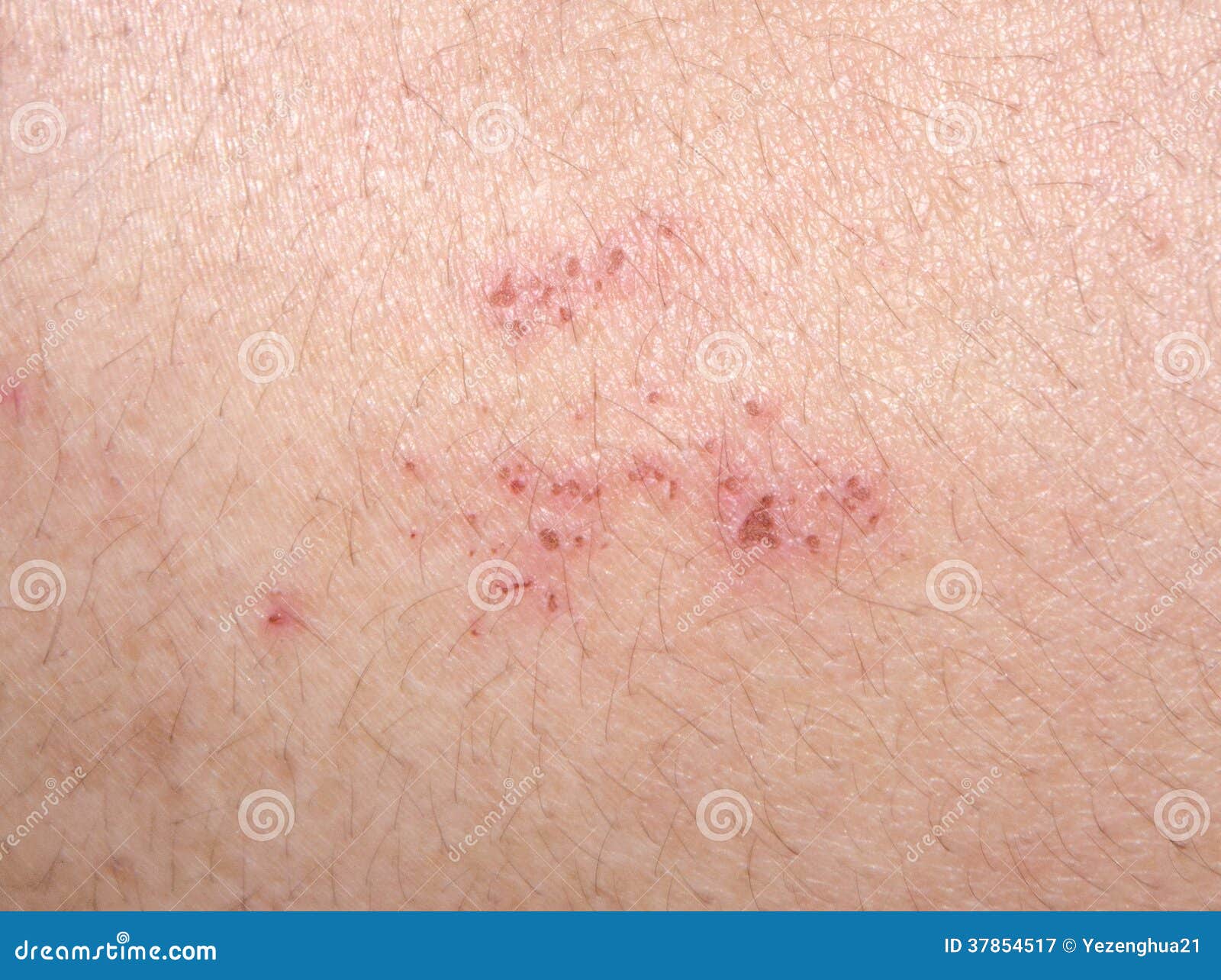 The damaged skin stock image. Image of detail, skin, rash - 37854517