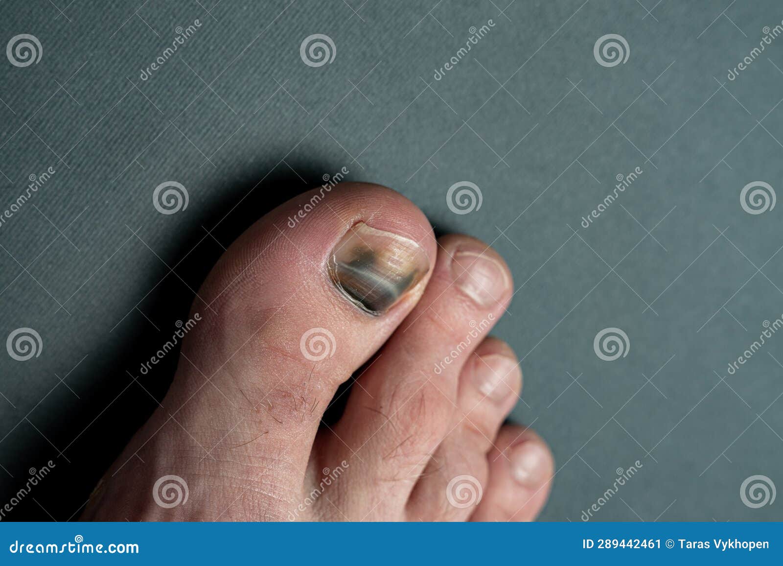 Damaged Toenail. Hematoma on the Thumb Stock Image - Image of trauma ...