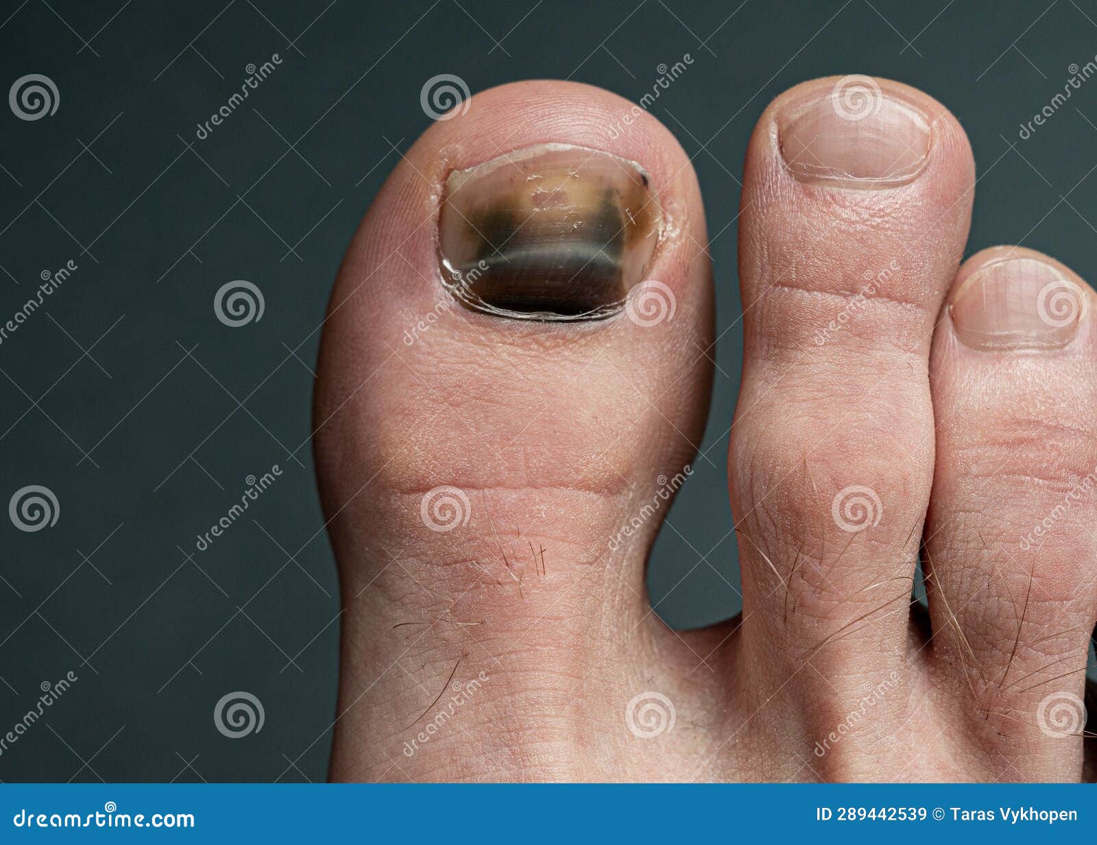 Damaged Toenail. Hematoma on the Thumb Stock Image - Image of finger ...