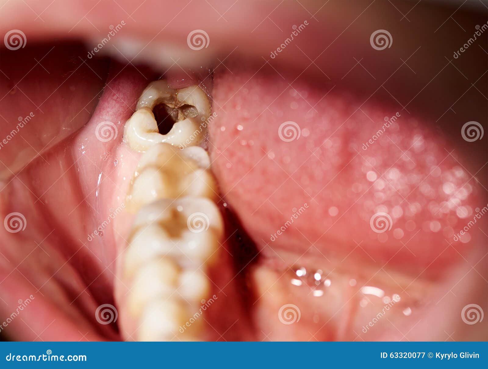 Damaged Tooth with Cavity Dental Caries Decay Stock Image - Image of ...