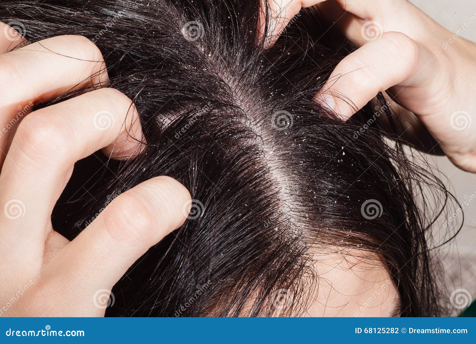 Dander that Causes Itching Scalp Stock Photo - Image of messy, problem ...
