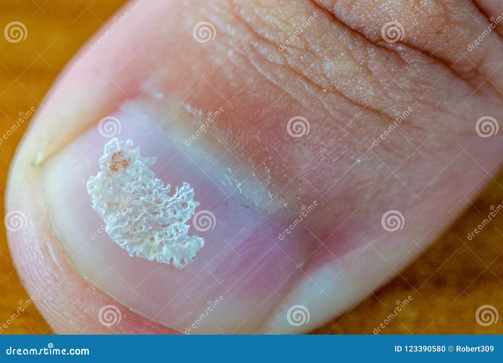 Dandruff Flake on Human Nail Stock Photo - Image of nail, hair: 123390580