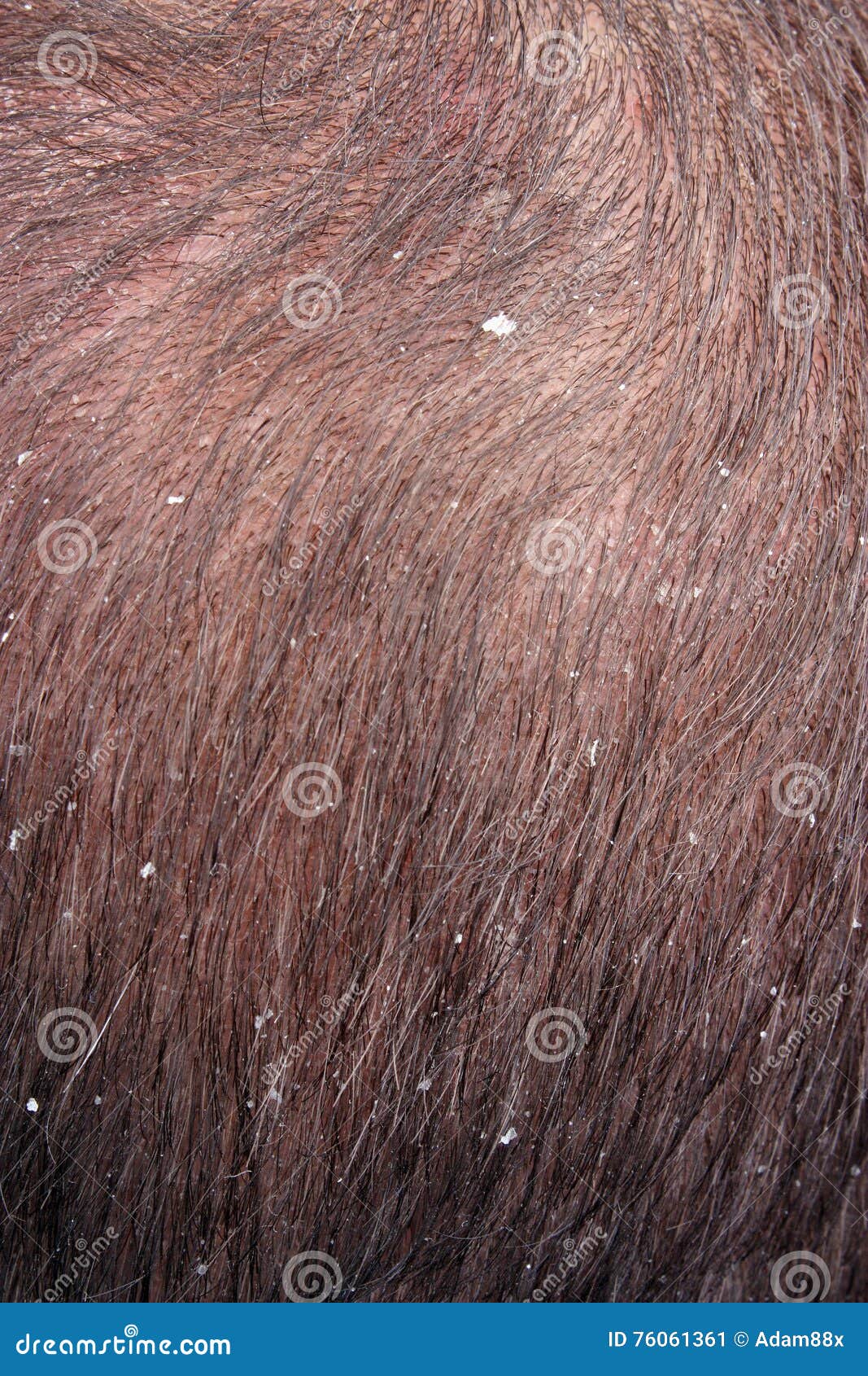 Dandruff in the hair stock image. Image of health, itch - 76061361