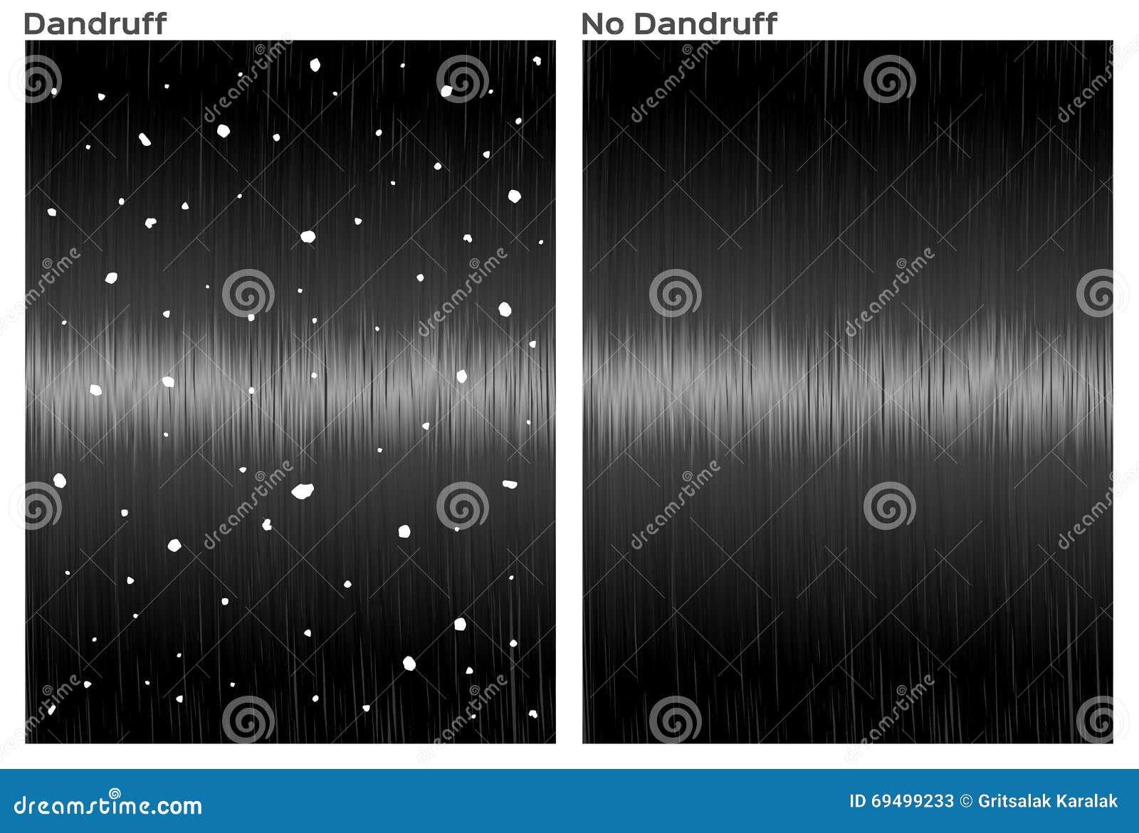 Dandruff On The Hair And Scalp Vector Illustration | CartoonDealer.com ...