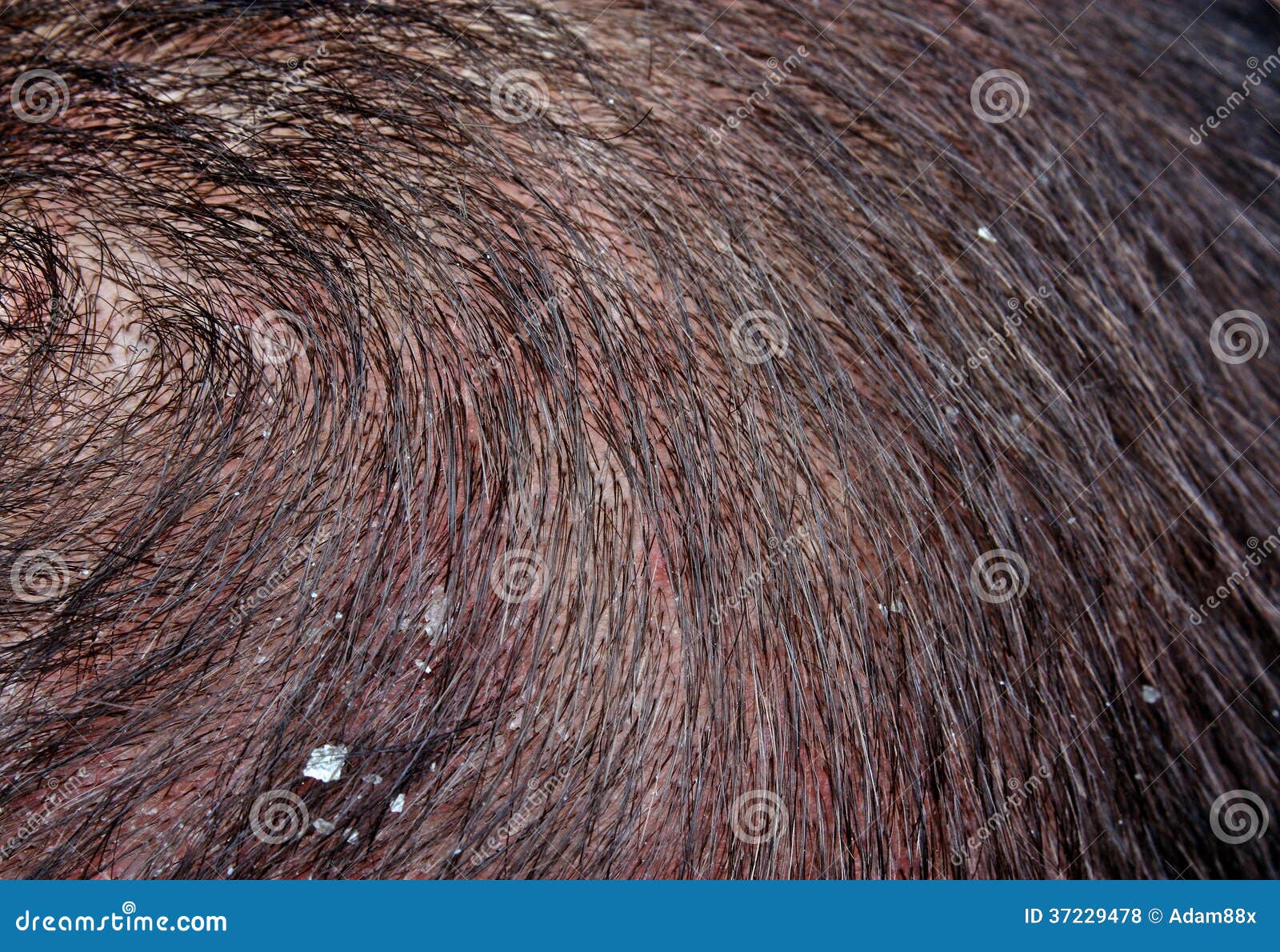 Dandruff in the hair stock photo. Image of dermatitis - 37229478