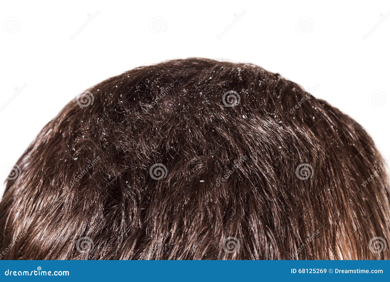 Dandruff Male Dark Hair on a White Background Stock Image - Image of ...
