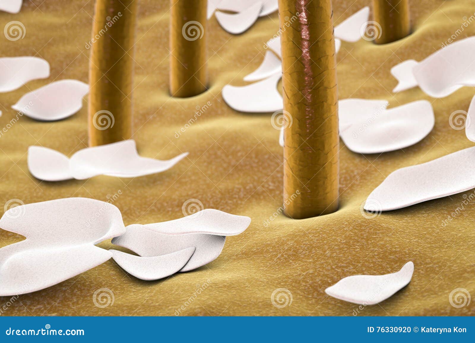 Dandruff. Skin Flakes On Itchy And Dry Scalp. Cross Section Of Skin ...