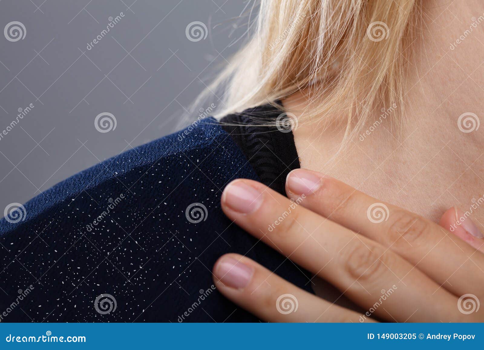 Dandruff on Woman`s Shoulder Stock Image - Image of fallen, itchy ...