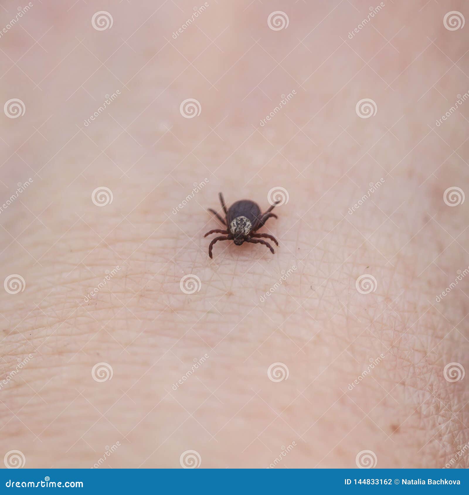 Contagious Insect a Tick Crawling on Human Skin Stock Photo - Image of ...