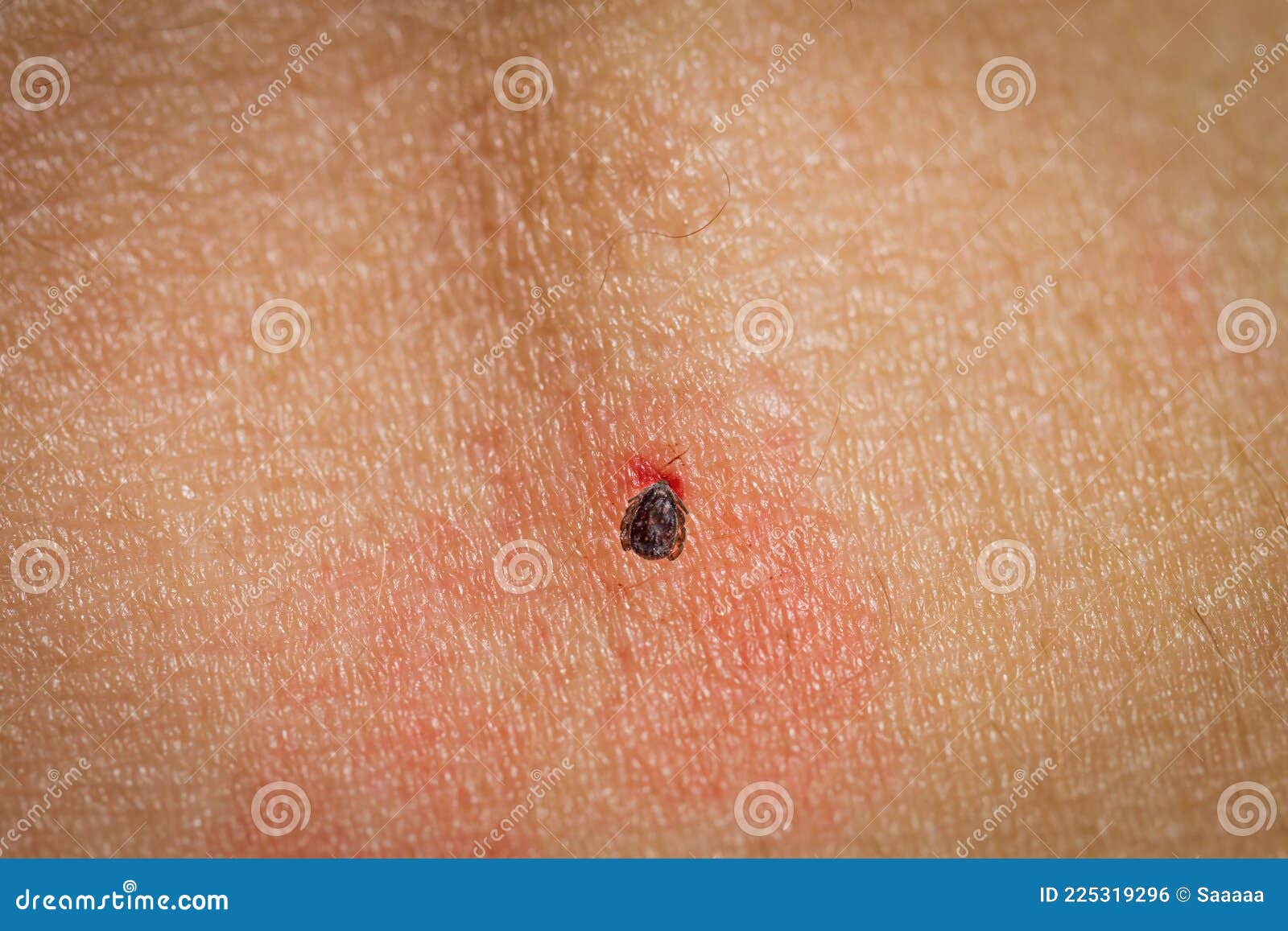 Dangerous Tick Over the Skin Closeup View Stock Photo - Image of blood ...