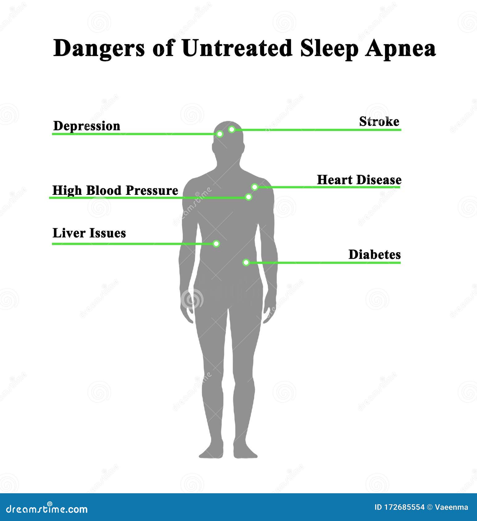 Untreated Sleep Apnea stock illustration. Illustration of stroke ...