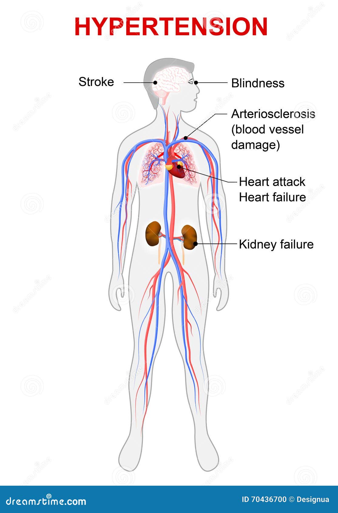 Danno da ipertensione illustrazione vettoriale. Illustrazione di ...