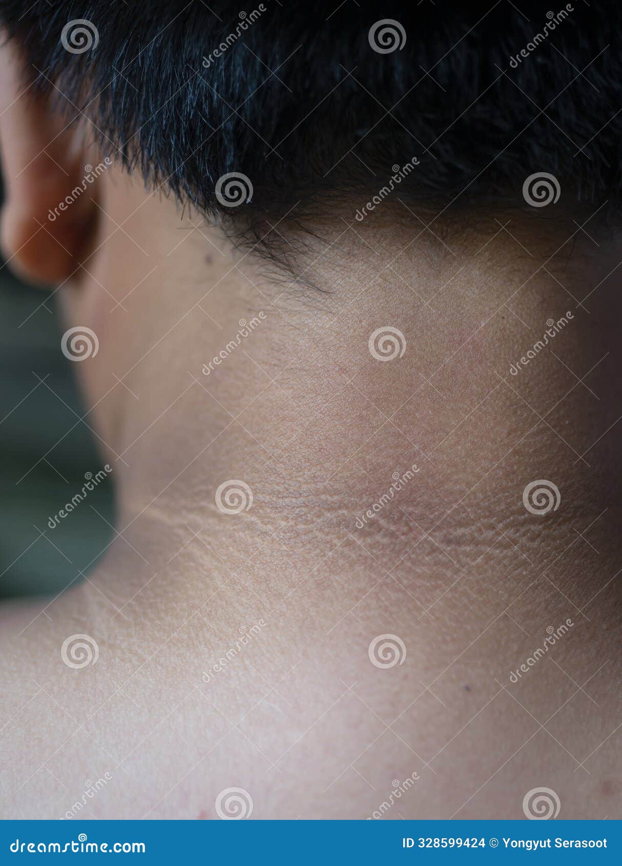 Dark Spots on the Skin of the Neck of a Person Stock Photo - Image of ...