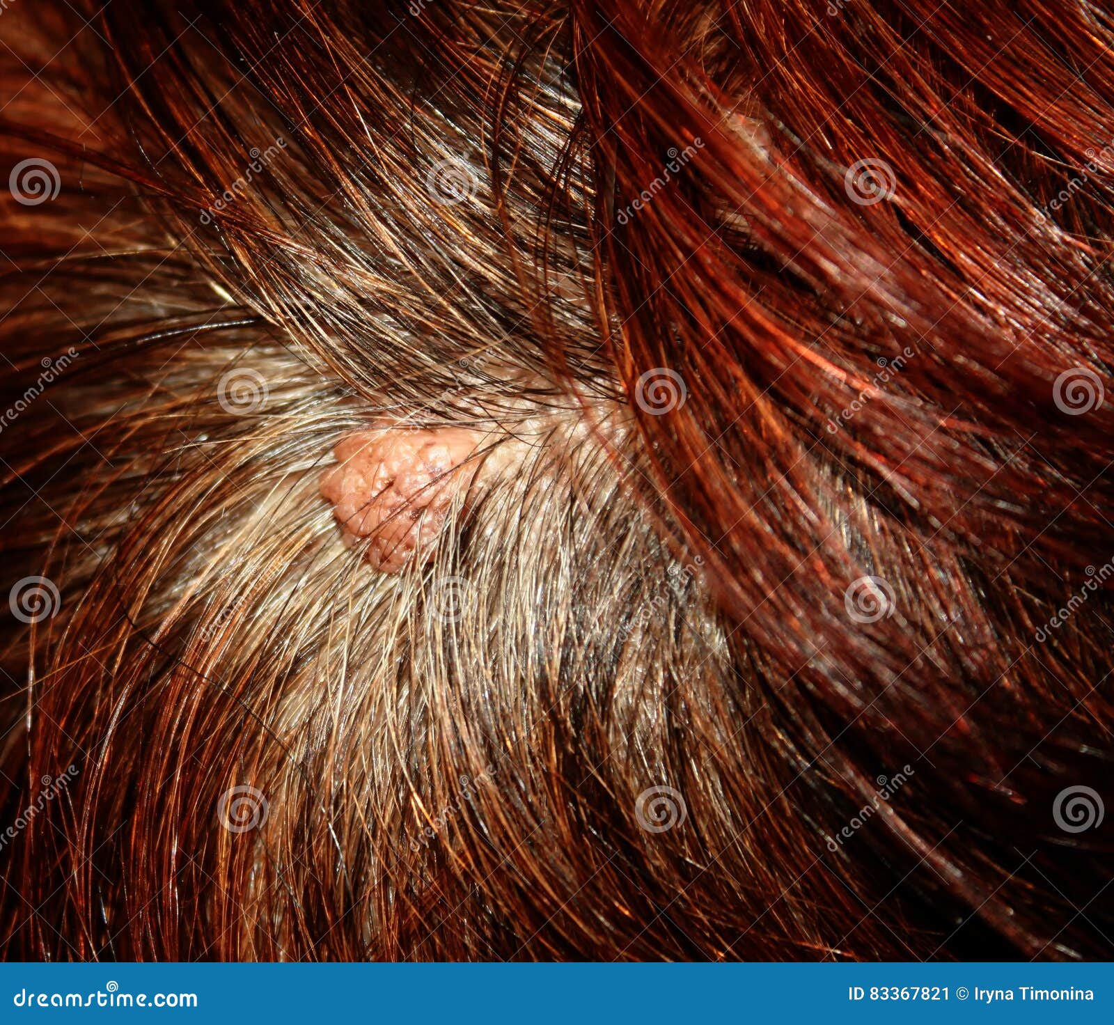 Das Muttermal Auf Seinem Kopf in Ihrem Haar Stockbild - Bild von ...