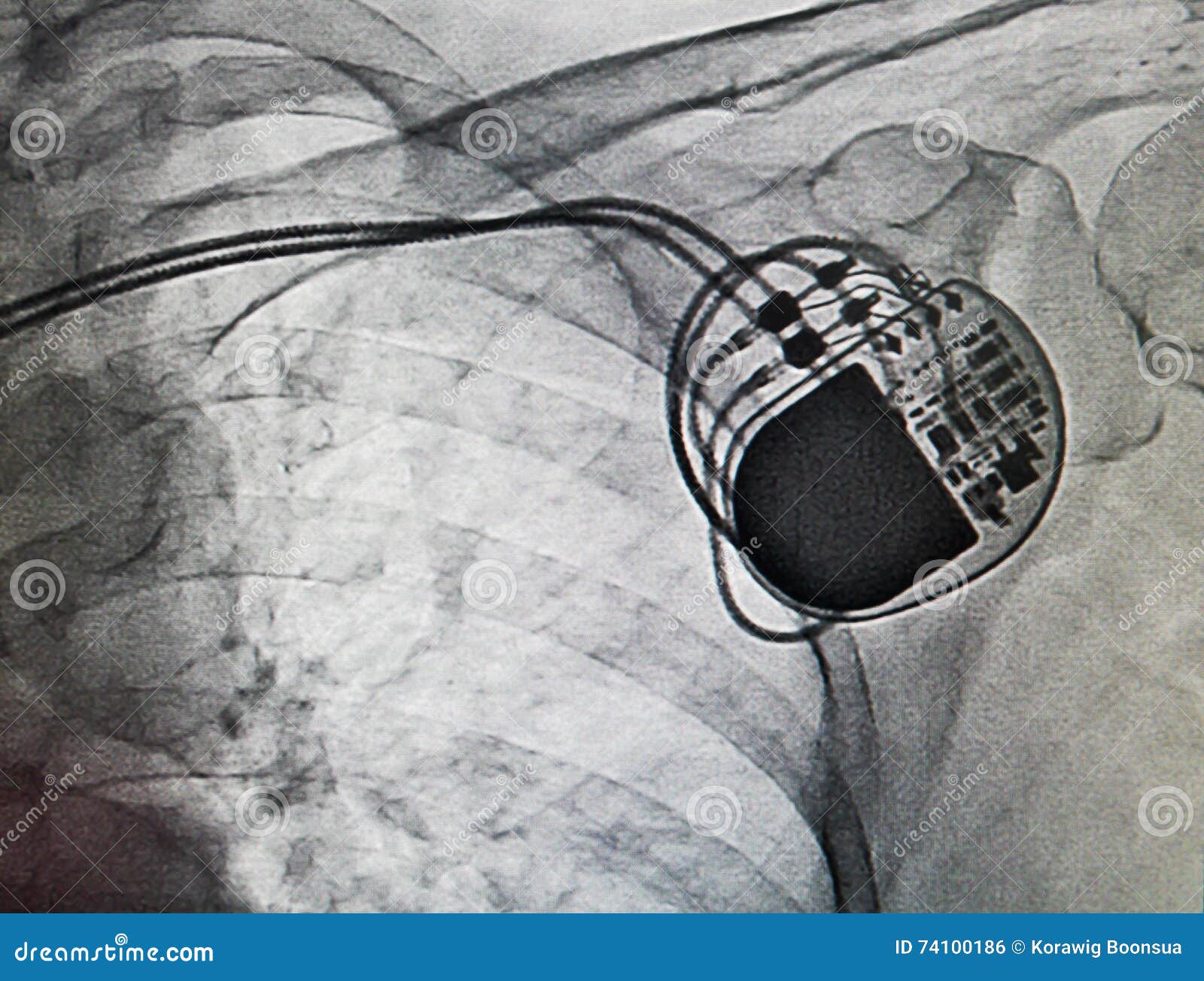 DDDR-pacemaker arkivfoto. Bild av diagnostisera, sjukdom - 74100186