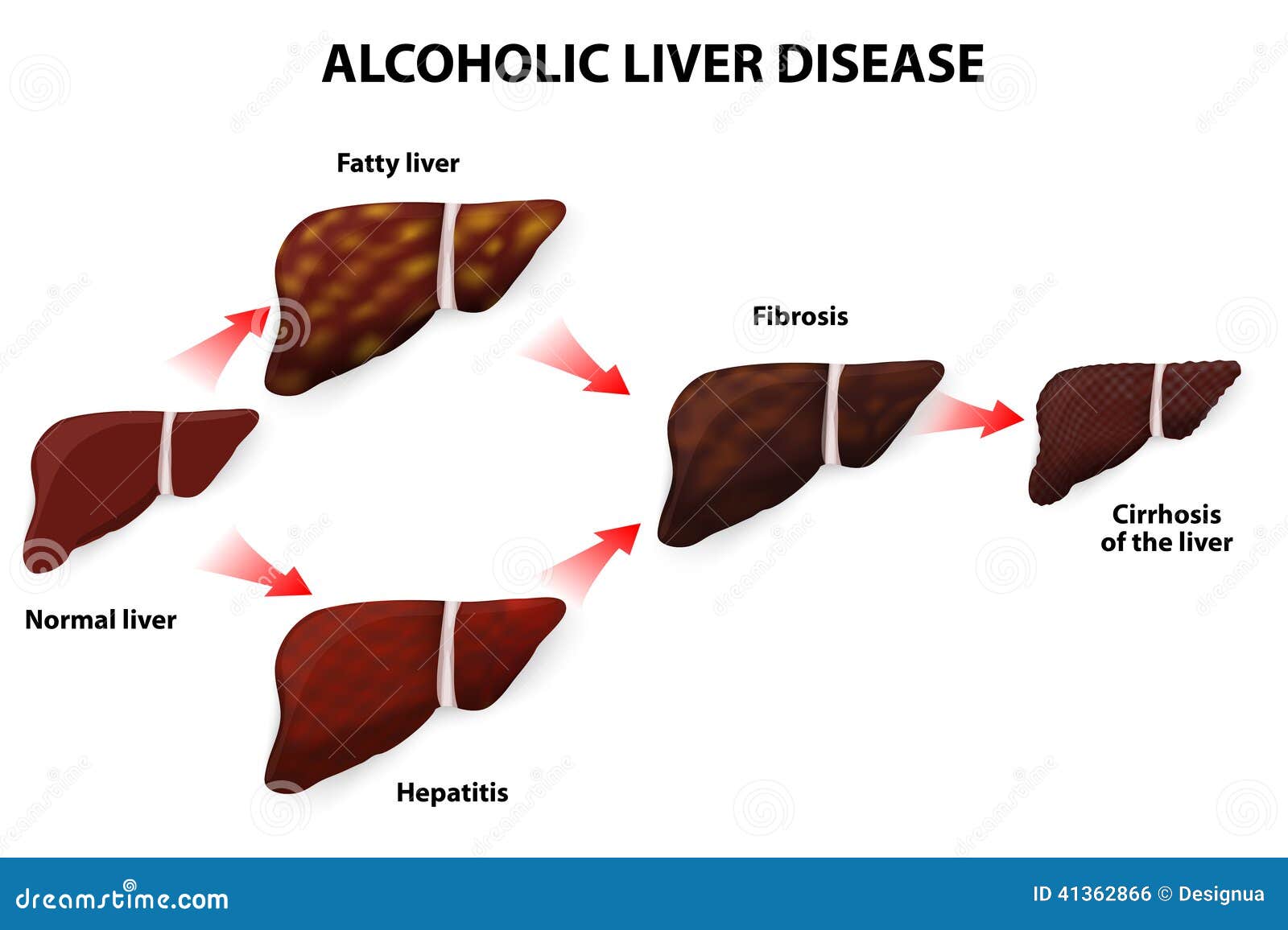 Alcoholische Menselijke Lever
