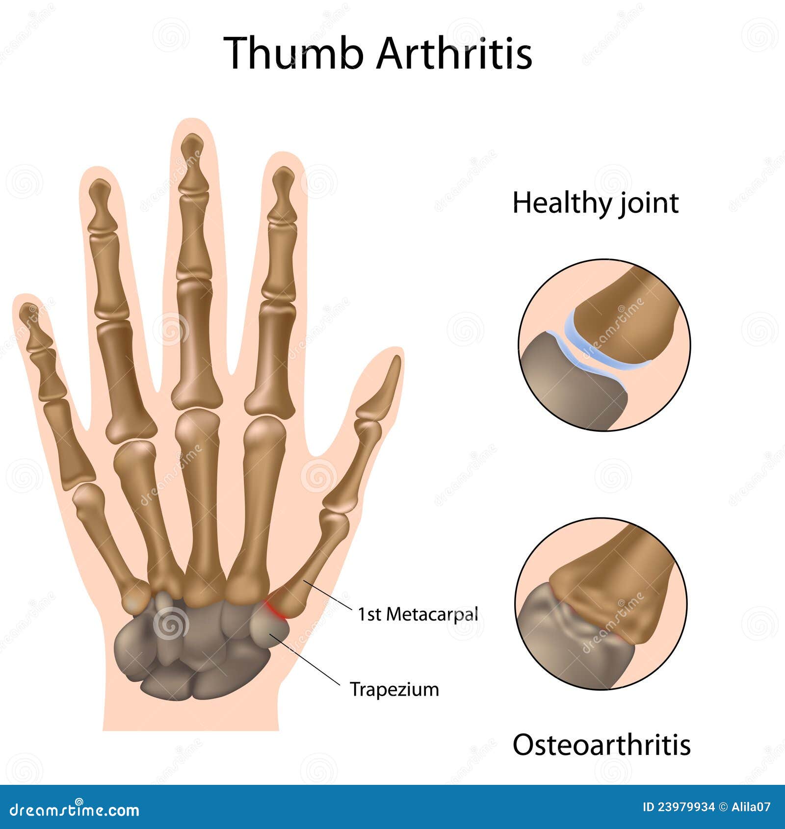 De artritis van de duim vector illustratie. Illustration of medisch ...