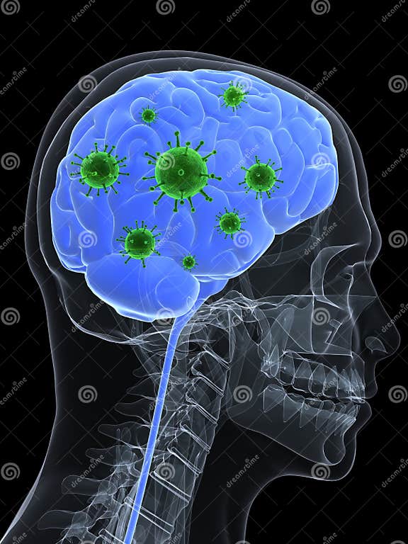 De besmetting van hersenen stock illustratie. Illustration of zieken ...