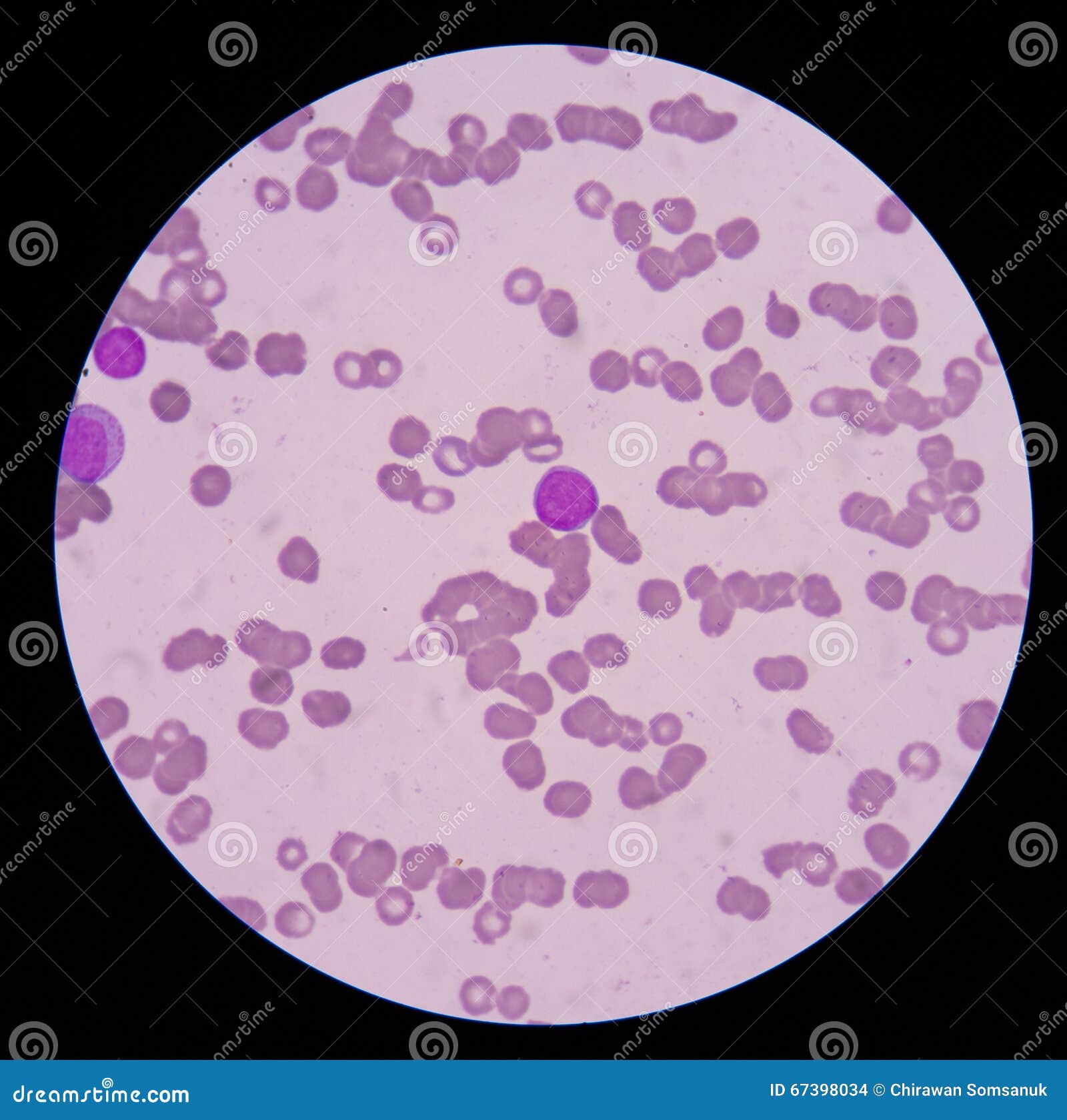 De Bloedvlek Toont Scherpe Myeloblastic Leukemie (AML) Stock Foto ...