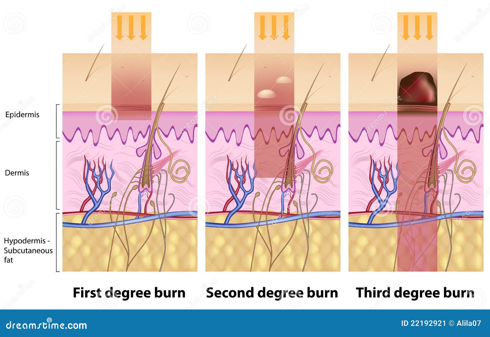 De brandwonden van de huid vector illustratie. Illustratie bestaande ...