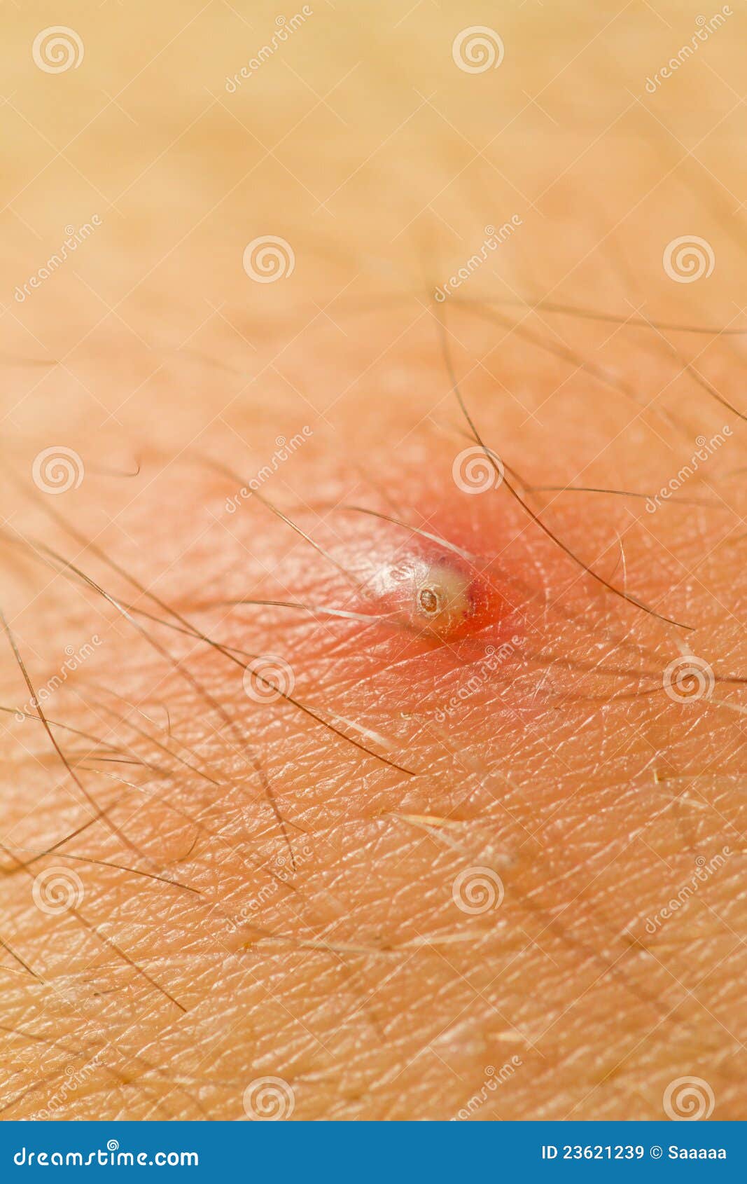 De Extreme Macro Van De Pukkel Stock Afbeelding - Image of hickey, buil ...