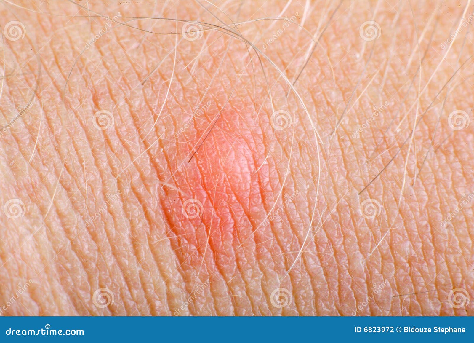 De Extreme Macro Van De Pukkel Stock Foto - Image of medisch ...