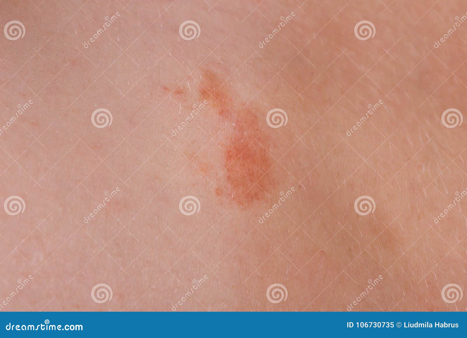 De Grote Rode Vlek Op De Huidclose-up Stock Afbeelding - Image of ...