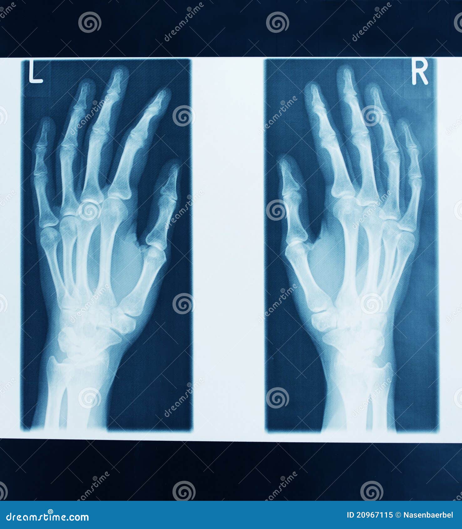 De Handen Van De Röntgenfoto Stock Afbeelding - Image of voorwaarde ...