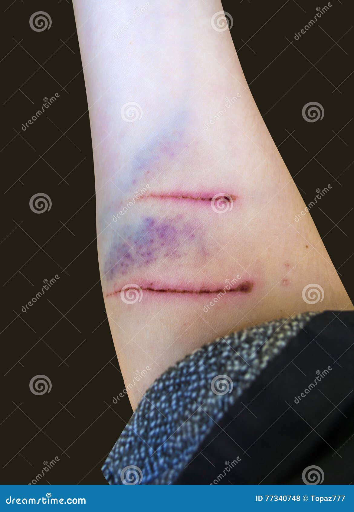 Images Morsure De Chien - Téléchargez 288 Photos libres de droits