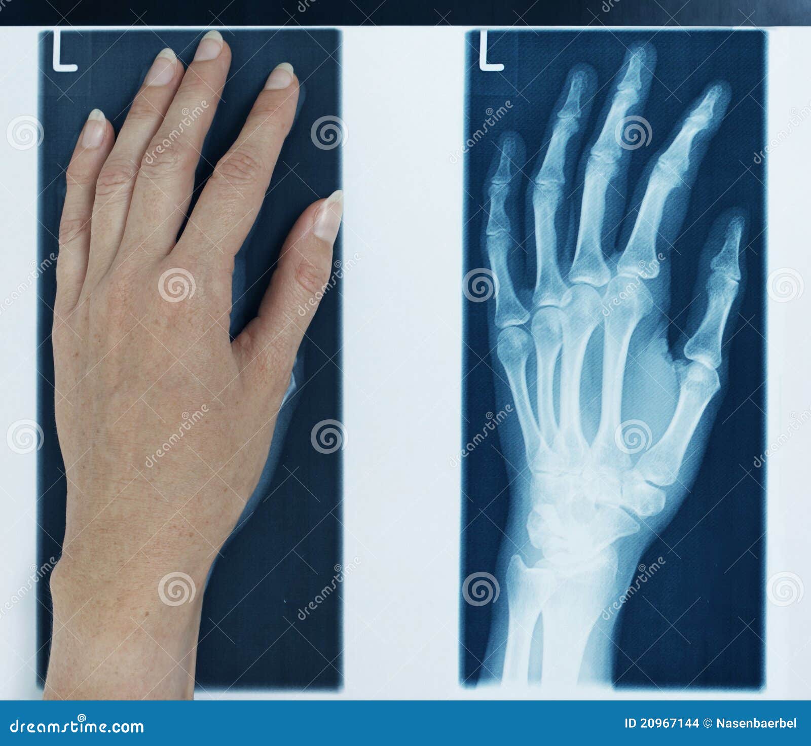 De Linkerhand Van De Röntgenfoto Stock Foto - Image of radioloog ...