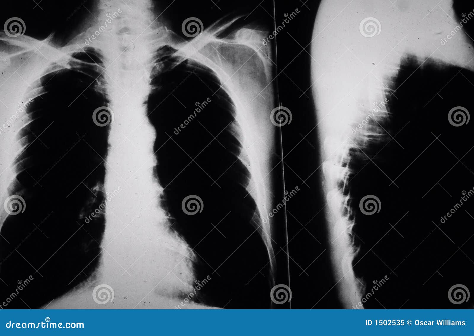 De Longen van rokers stock afbeelding. Image of tabak - 1502535