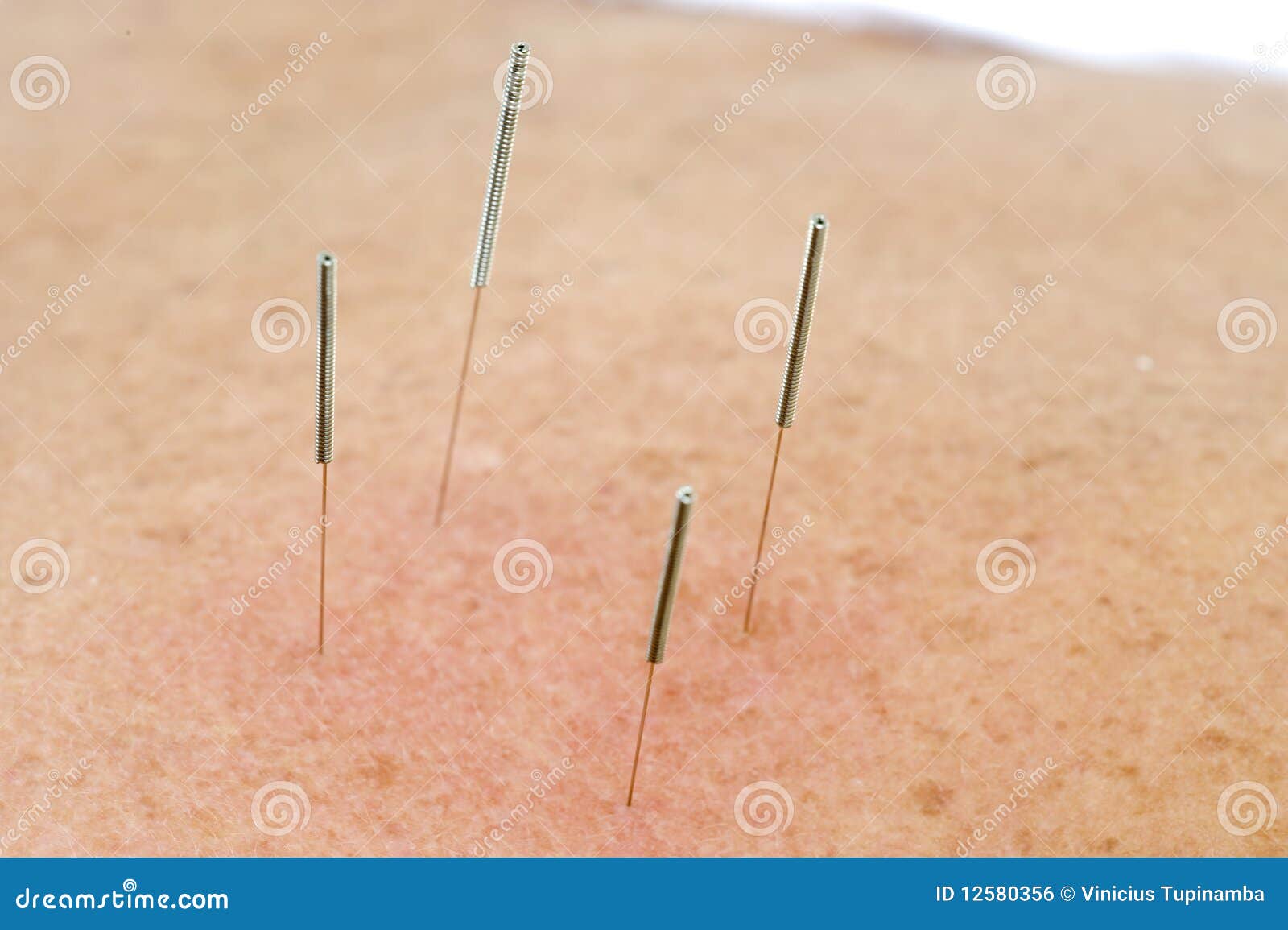 De Naalden Van De Acupunctuur in Ruggen Stock Foto - Image of naalden ...