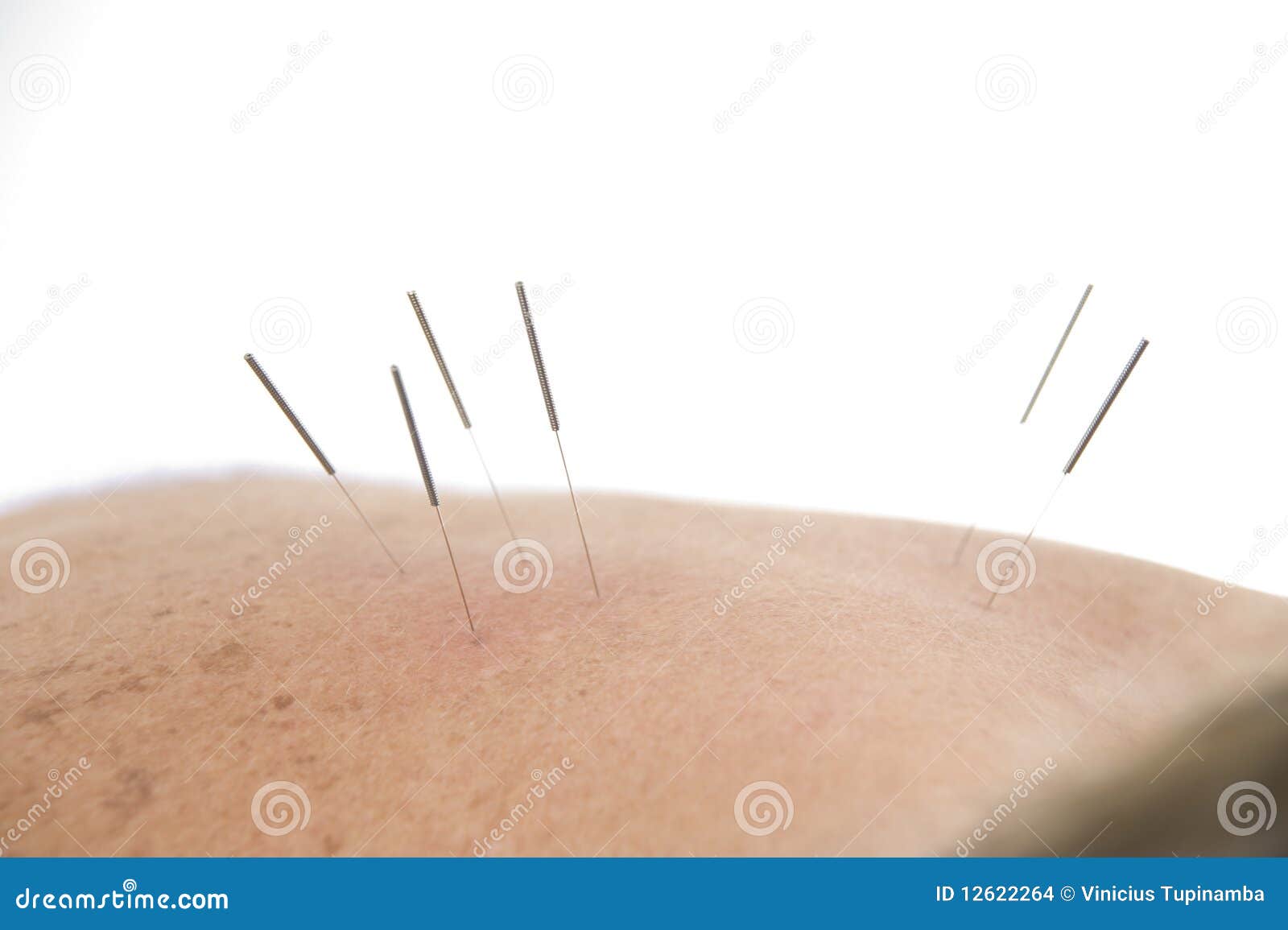 De Naalden Van De Acupunctuur in Ruggen Stock Foto - Image of ...