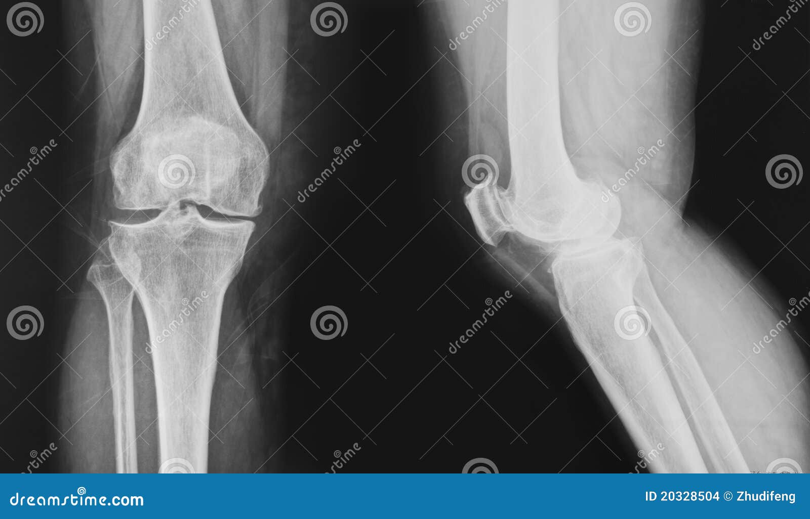 De Normale Knie Van De Röntgenstraal Stock Foto - Image of been ...